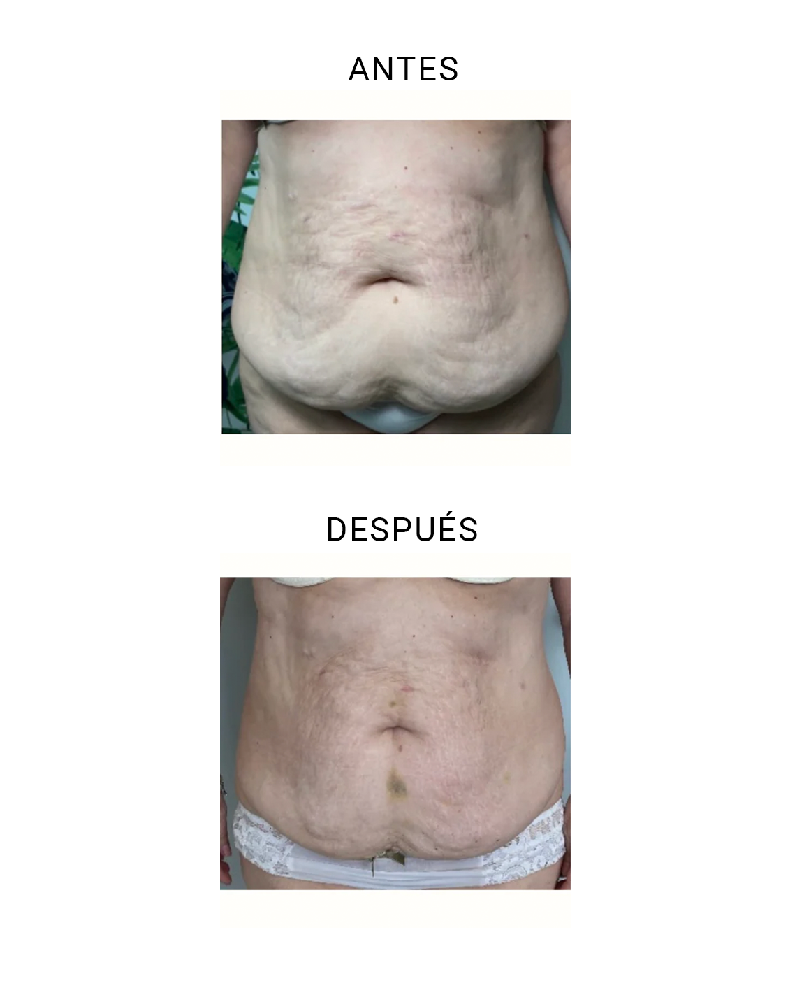 Tratamiento para la Flacidez Corporal | Clínica Ora Estética Avanzada ...